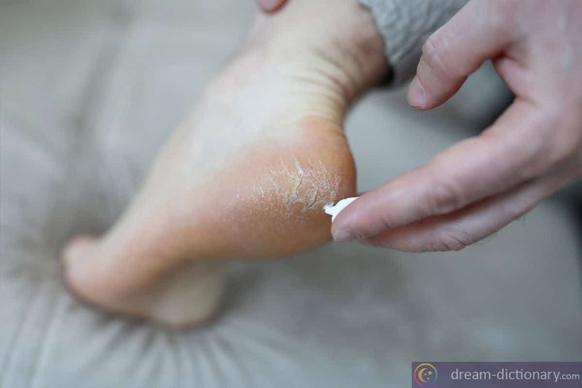 Callus Dream Meaning - Dream Dictionary